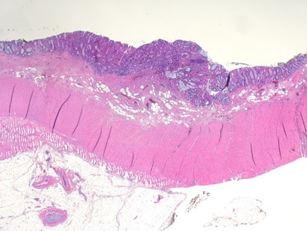 colonic FTRD® - Ovesco Endoscopy AG