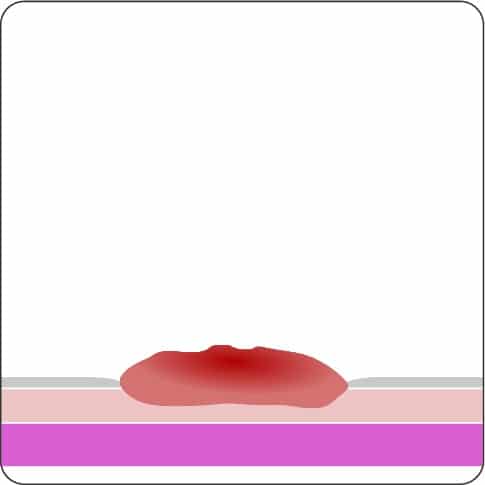 colonic FTRD® - Ovesco Endoscopy AG