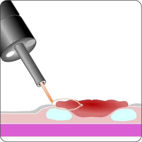 colonic FTRD® - Ovesco Endoscopy AG