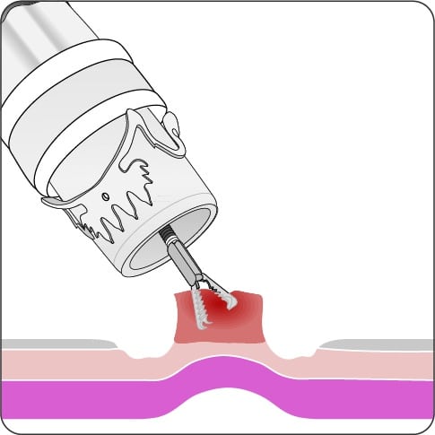 colonic FTRD® - Ovesco Endoscopy AG