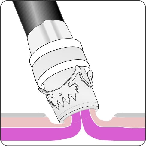 colonic FTRD® - Ovesco Endoscopy AG