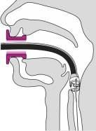gastroduodenal FTRD® - Ovesco Endoscopy AG