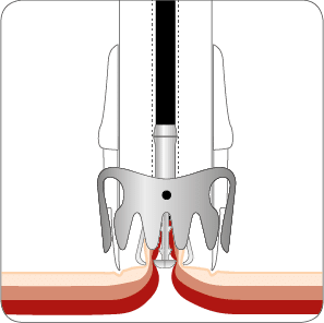 OTSC® System Set - Ovesco Endoscopy AG