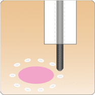 colonic FTRD® - Ovesco Endoscopy AG
