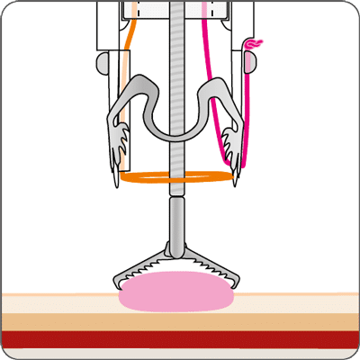 gastroduodenal FTRD® - Ovesco Endoscopy AG