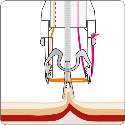 diagnostic FTRD® - Ovesco Endoscopy AG