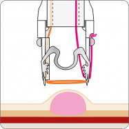 gastroduodenal FTRD® - Ovesco Endoscopy AG